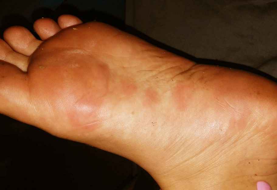 Ringworm On Foot Pictures Causes And Treatment Ringworm On Foot Pictures Causes And Treatment